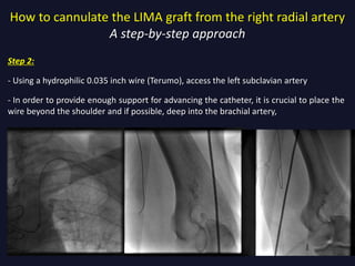 Bagur R - AIMRADIAL 2014 Technical - Cannulate the LIMA | PPTX