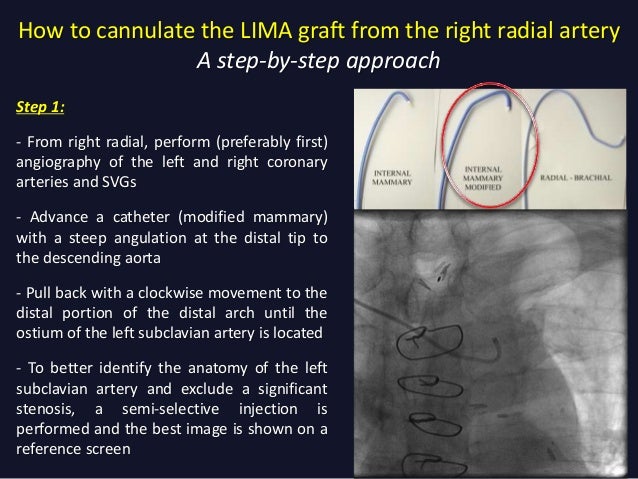 Bagur R - AIMRADIAL 2014 Technical - Cannulate the LIMA