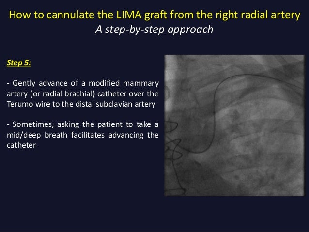 Bagur R - AIMRADIAL 2014 Technical - Cannulate the LIMA