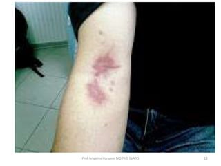 How to cope with tomcat bite | PPT