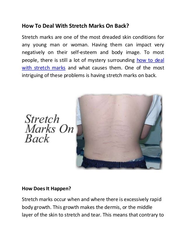 How To Deal With Stretch Marks On Back?