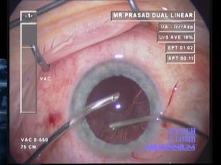 Anterior Vitrectomy Process by Dr Somdutt Prasad at APACRS 2015 | PPS