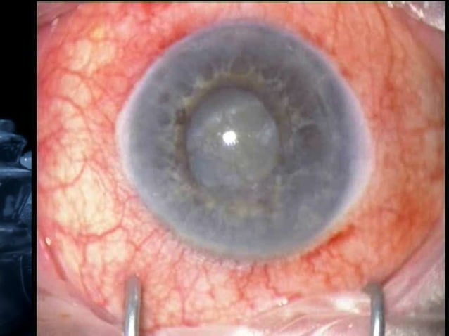 Anterior Vitrectomy Process by Dr Somdutt Prasad at APACRS 2015 | PPS ...