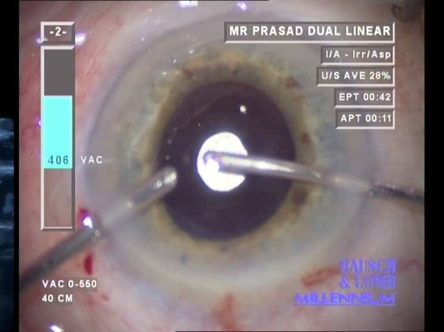 Anterior Vitrectomy Process by Dr Somdutt Prasad at APACRS 2015 | PPS ...