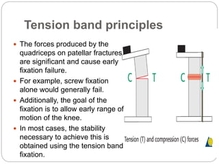 How to do tension band wire | PPTX