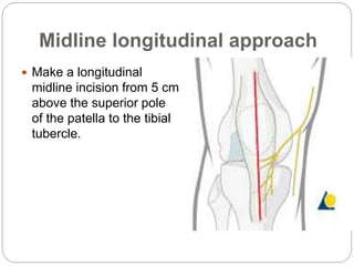 How to do tension band wire | PPTX