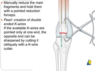 How to do tension band wire | PPTX