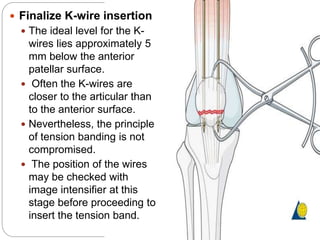 How to do tension band wire | PPTX