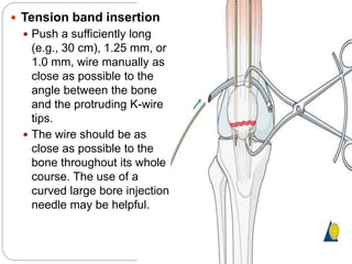 How to do tension band wire | PPTX