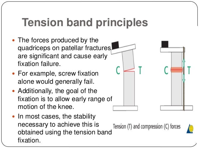 How to do tension band wire