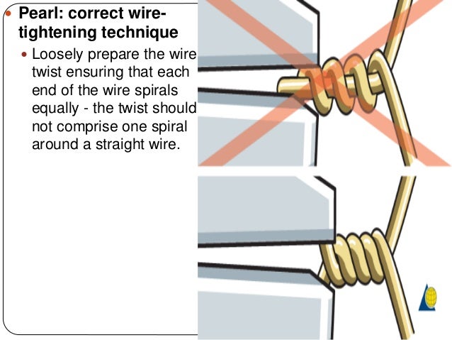 How to do tension band wire