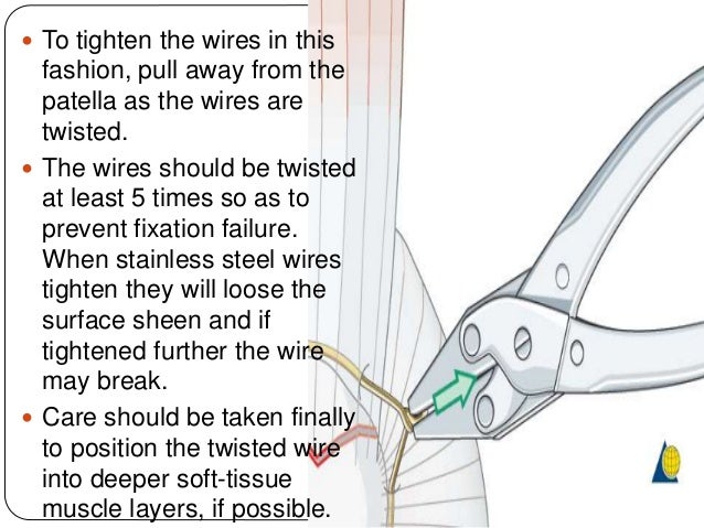 How To Do Tension Band Wire