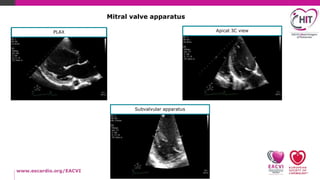 How to echo-Mitral regurgitation-Practical tips | PPT