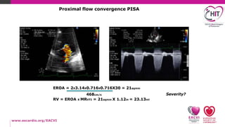 How to echo-Mitral regurgitation-Practical tips | PPT