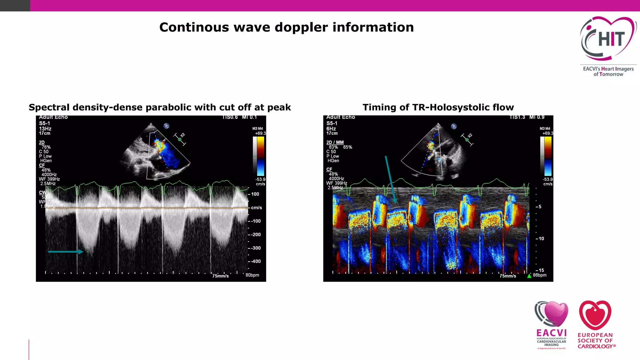 How to echo... tricuspid regurgitation.ppt