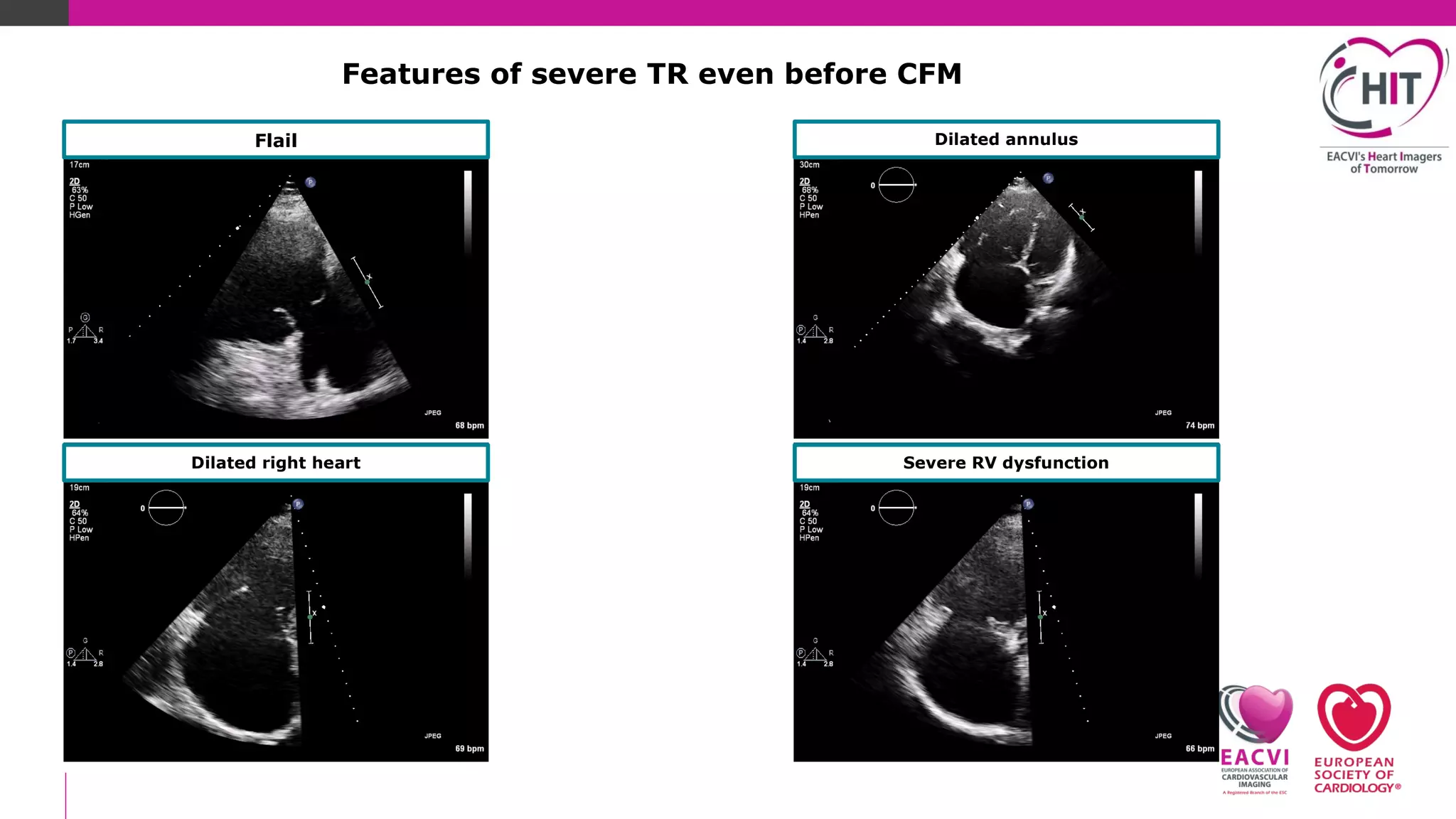 How to echo... tricuspid regurgitation.ppt