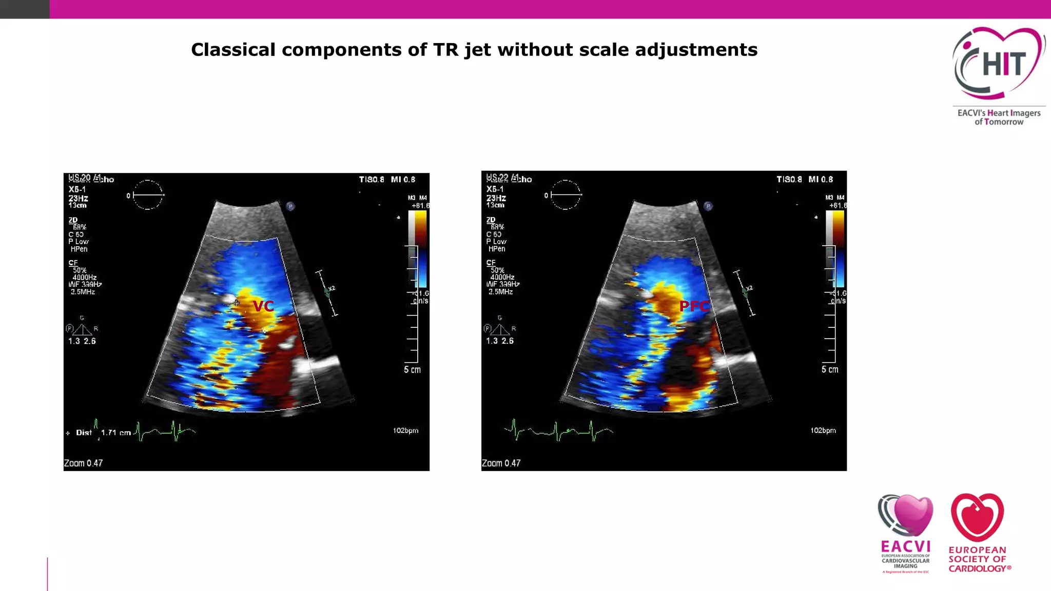 How to echo... tricuspid regurgitation.ppt