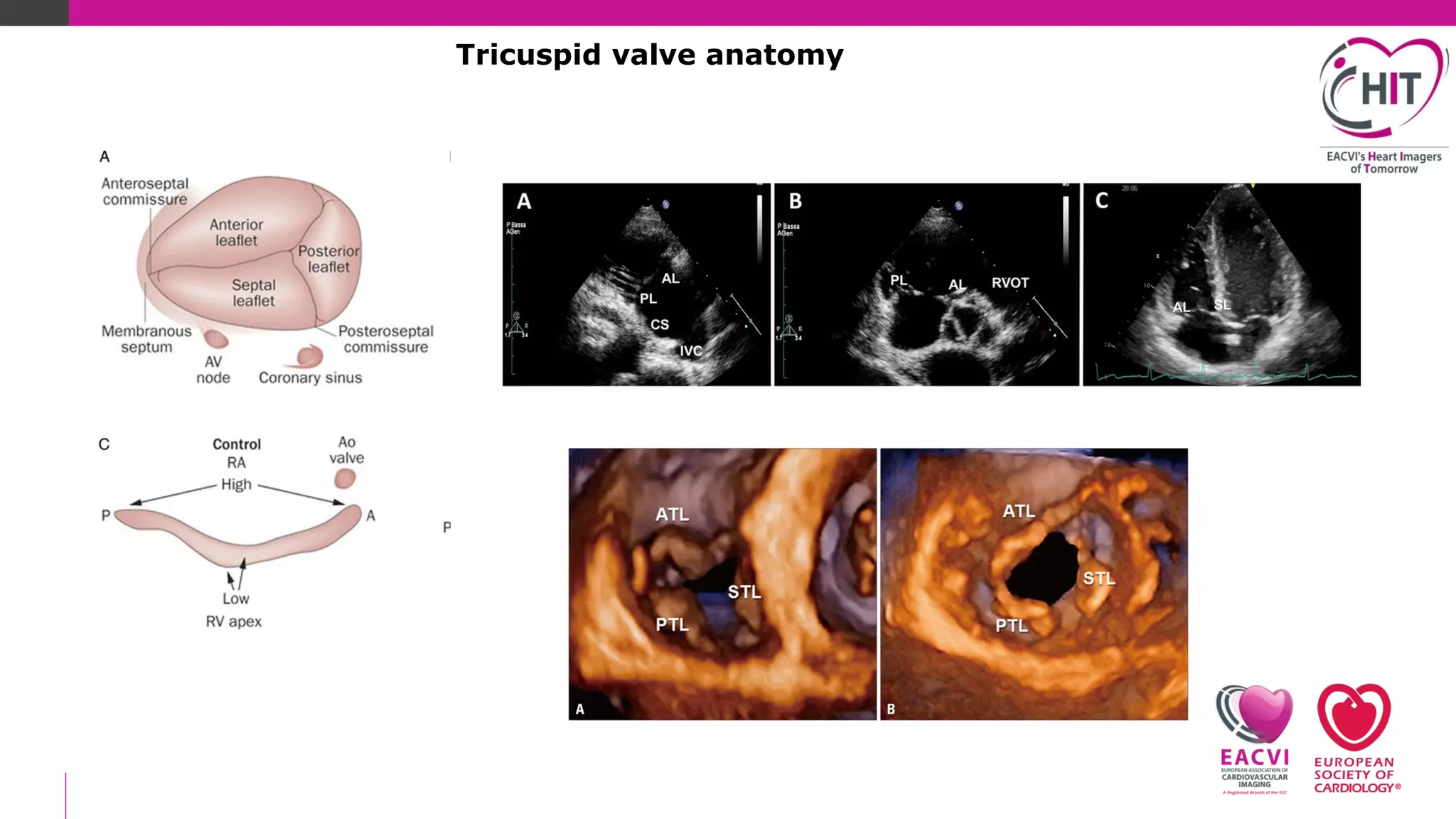 How to echo... tricuspid regurgitation.ppt