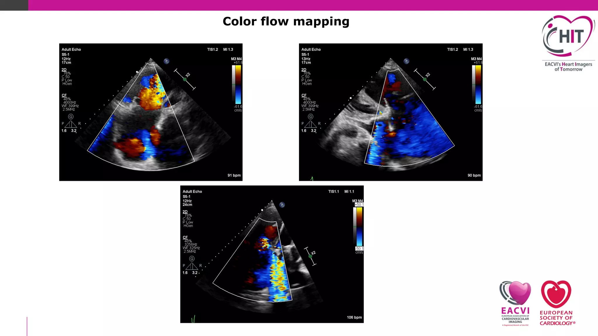 How to echo... tricuspid regurgitation.ppt