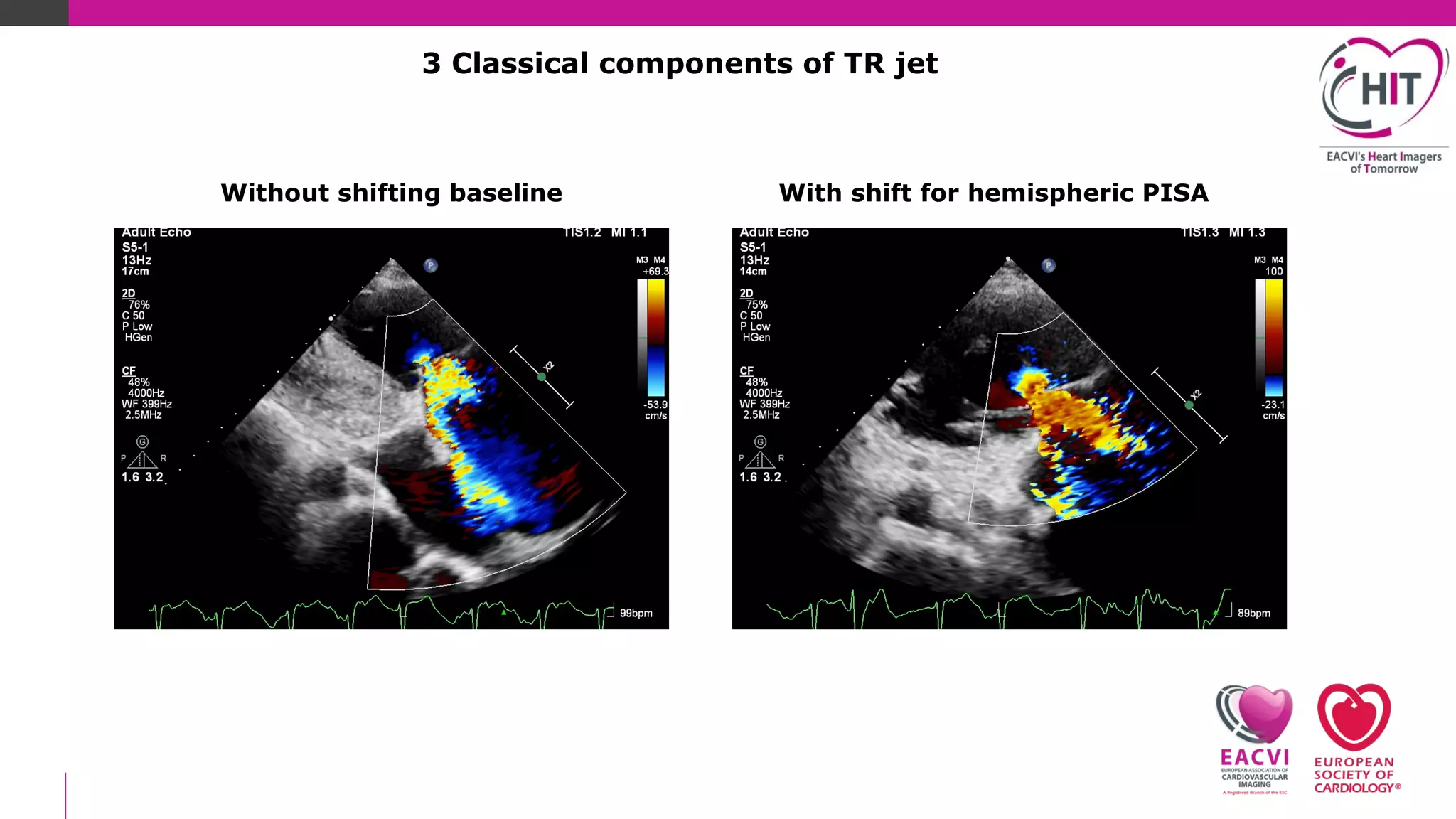 How to echo... tricuspid regurgitation.ppt