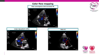How to echo... tricuspid regurgitation.ppt