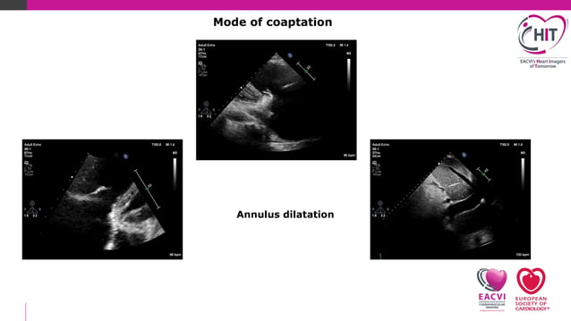 How to echo... tricuspid regurgitation.ppt