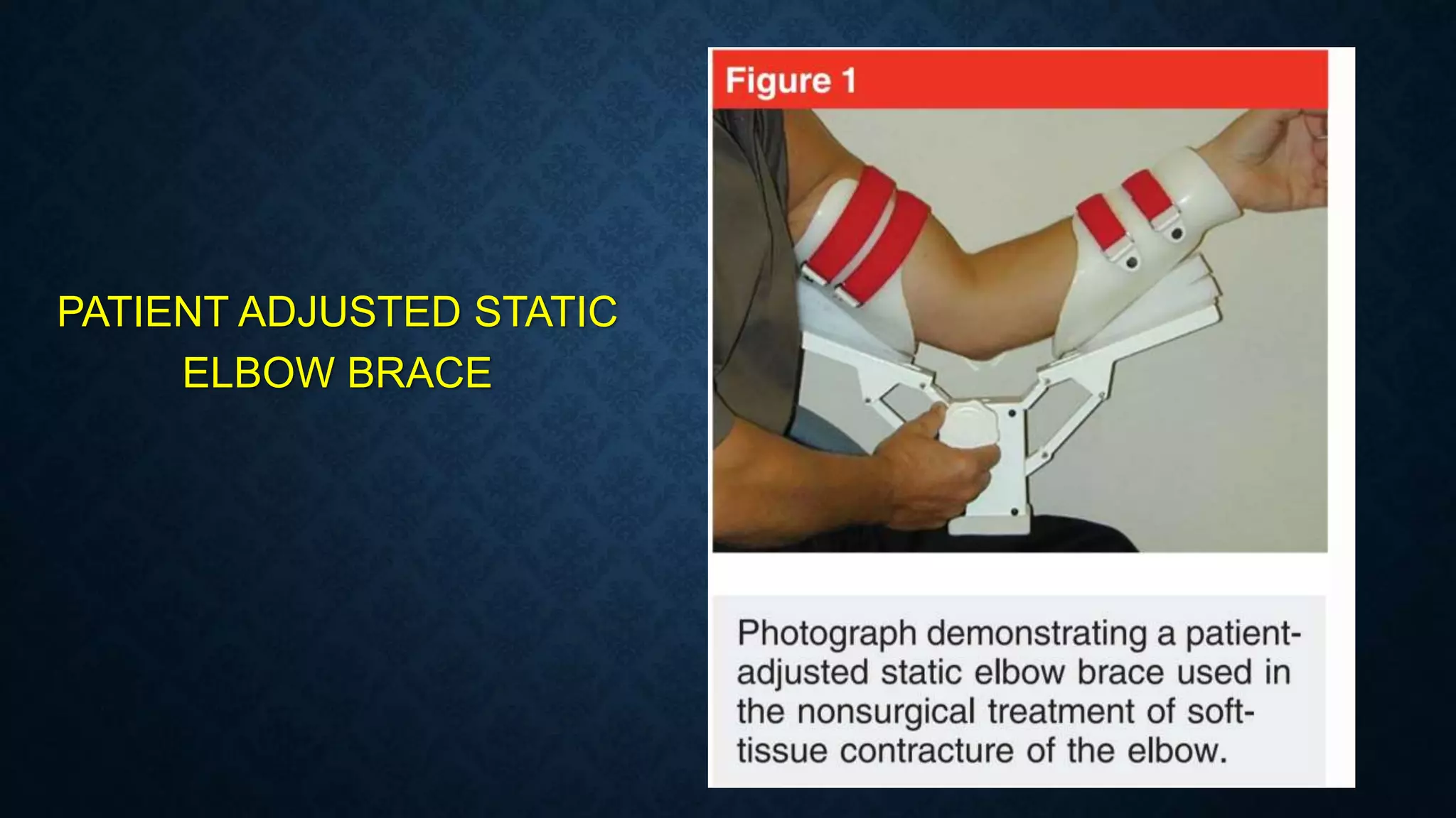 How to manage elbow stiffness | PPTX