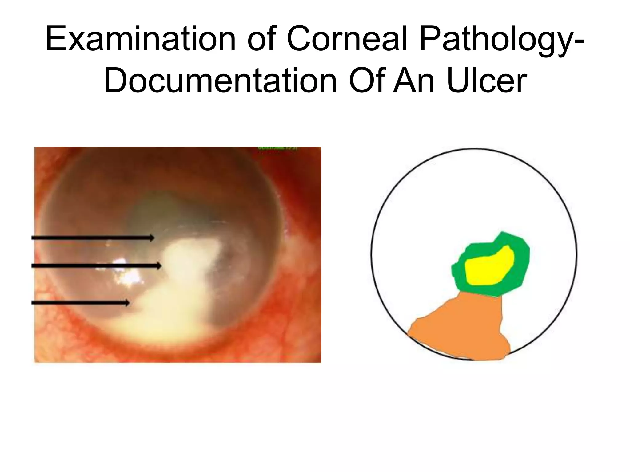 How to examine a corneal pathology-basics | PPTX | Eye and Vision ...