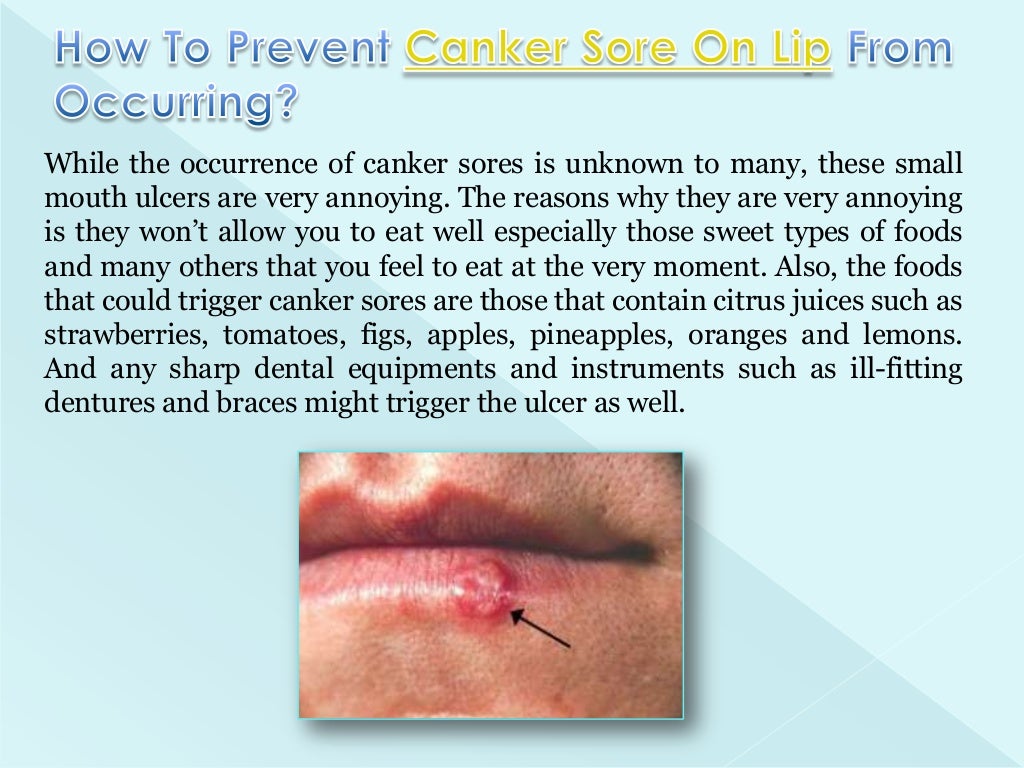 What Is A Canker Sore