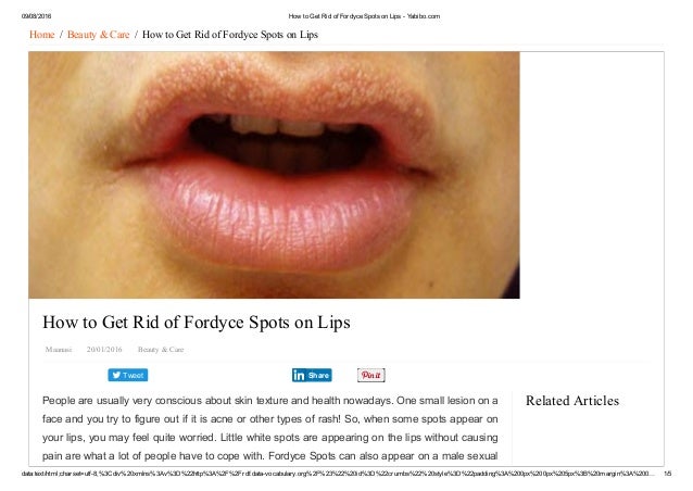 12 Ways To Get Rid Of Fordyce Spots On Lips – RIKW