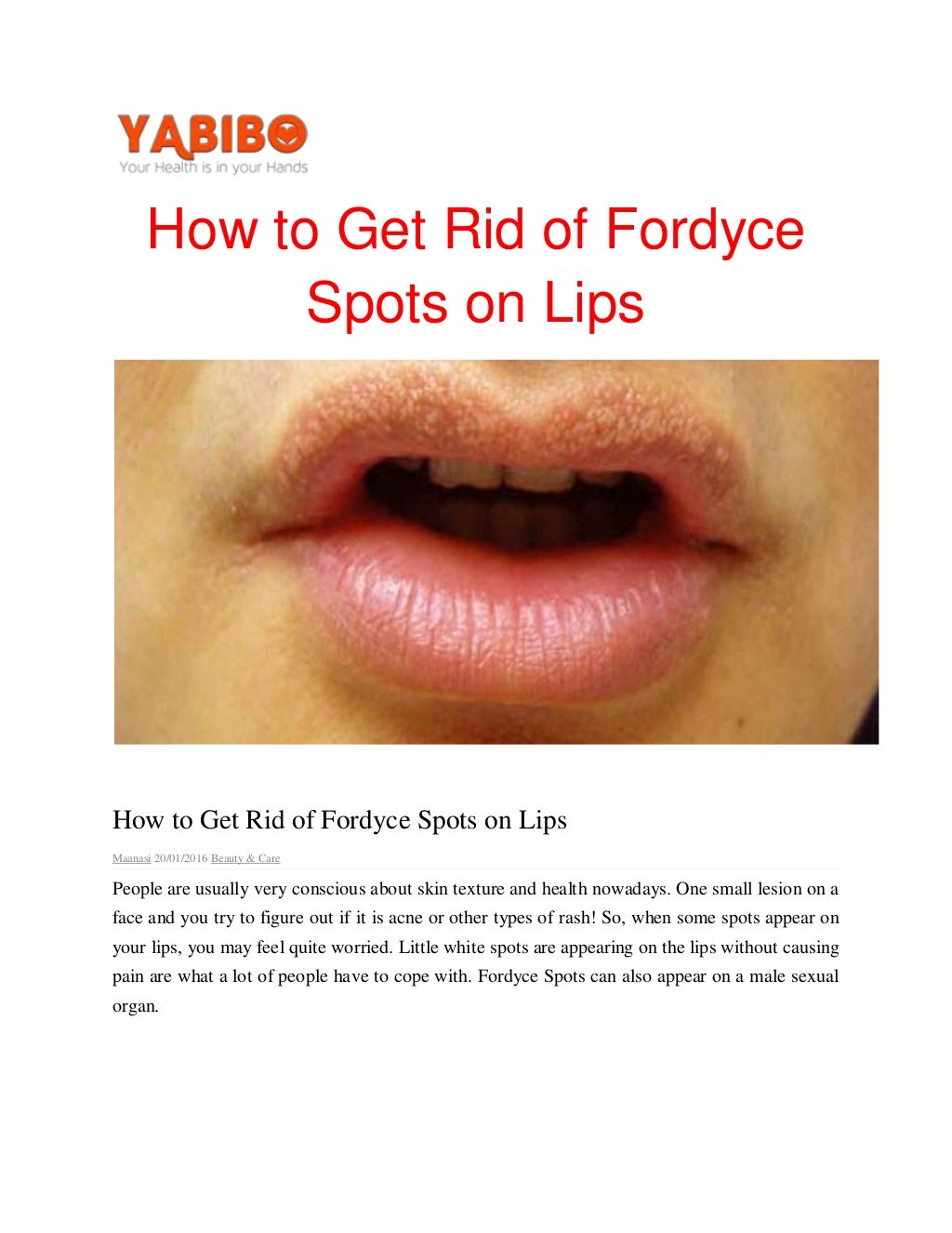 How To Get Rid Of Fordyce Spots On Lips how-to-get-rid-of-fordyce-spots-on-lips