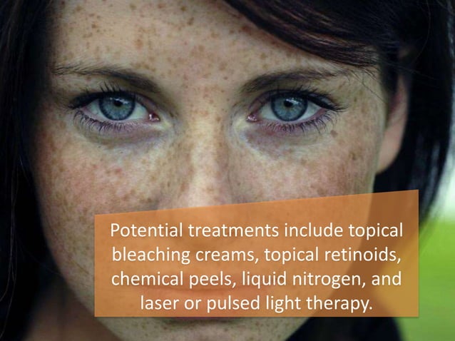 How to Get Rid of Freckles – Treatment Options for Freckle Removal | PPT