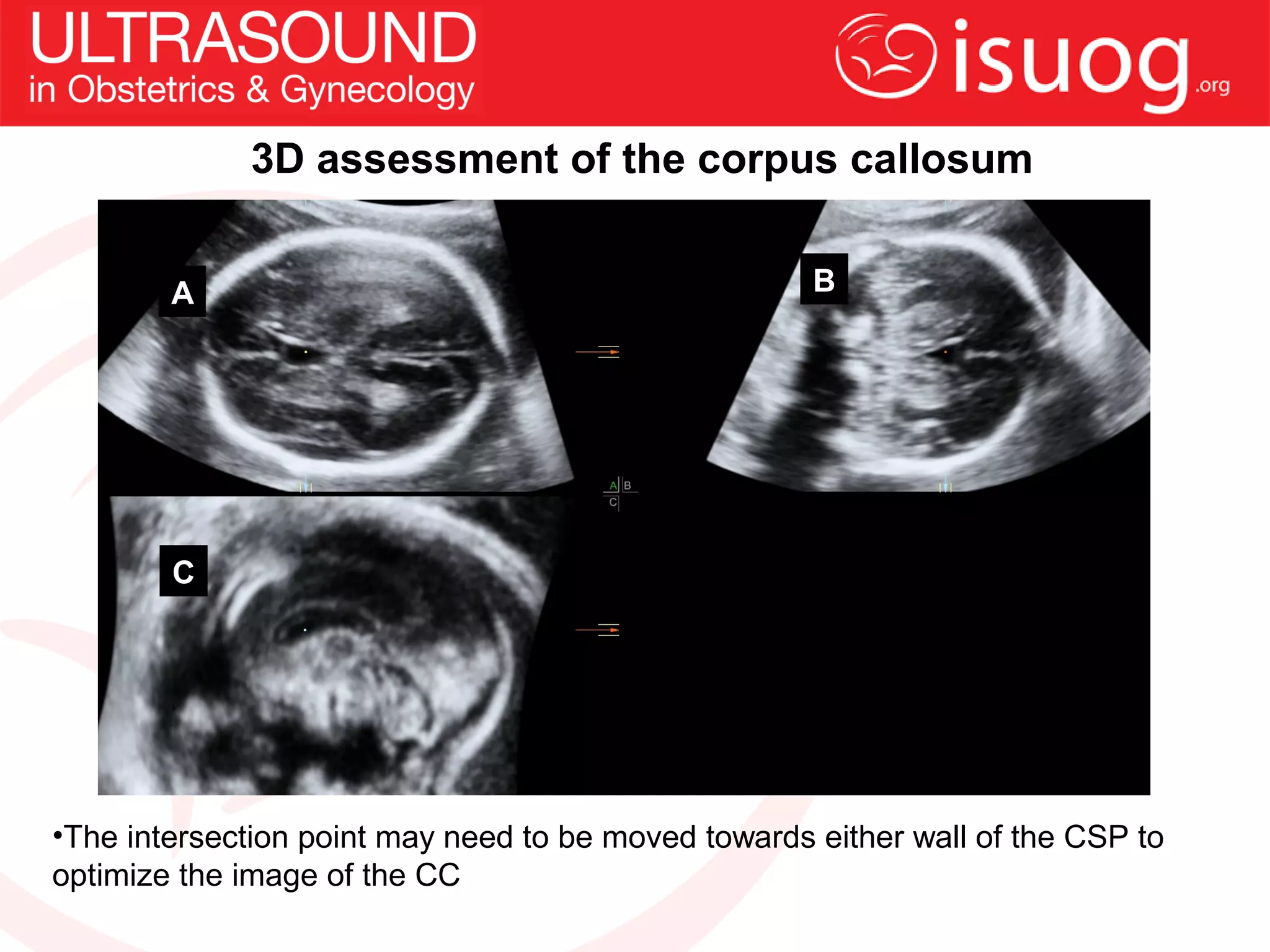 How to image the fetal corpus callosum | PPT