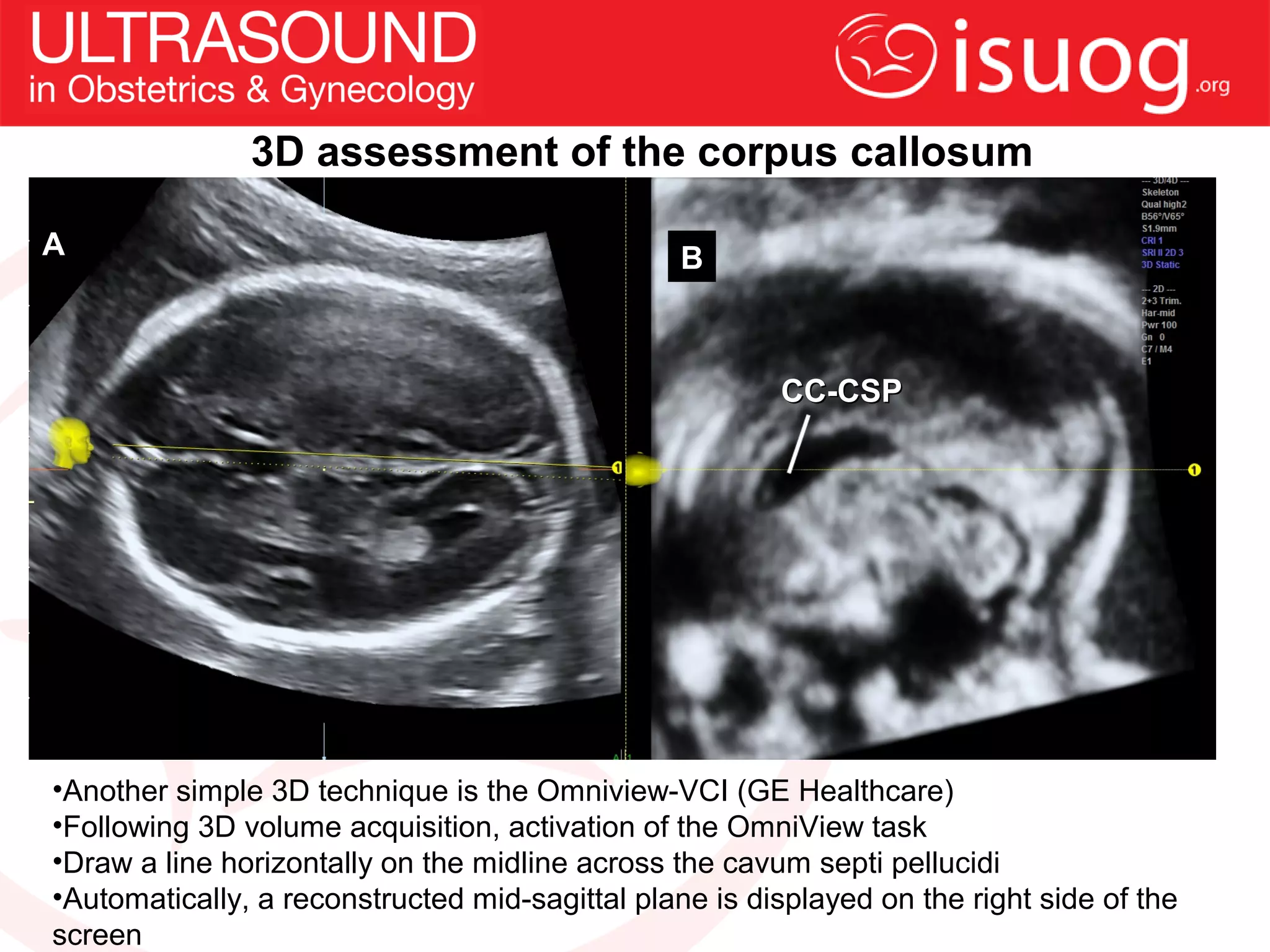 How to image the fetal corpus callosum | PPT