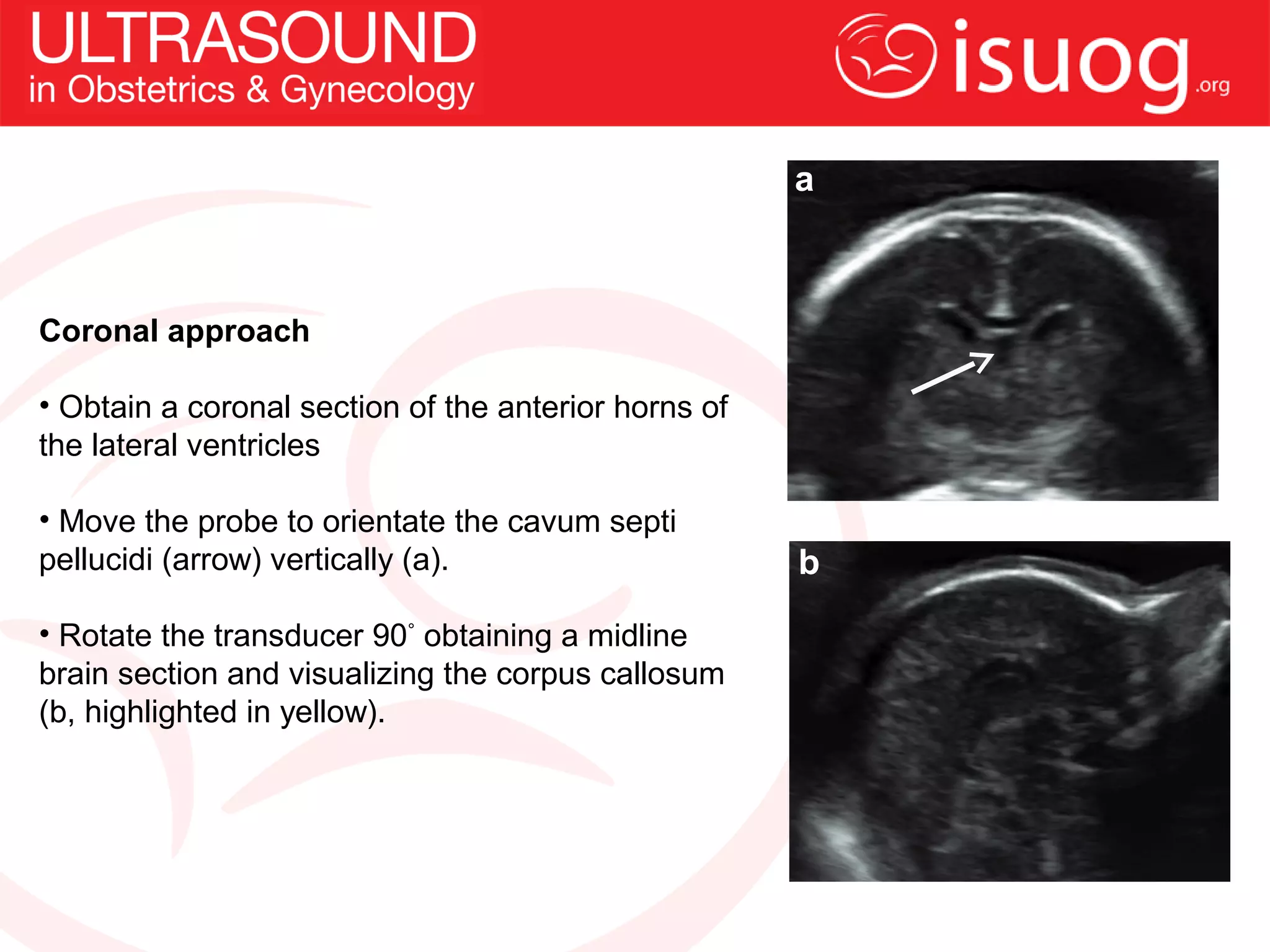 How to image the fetal corpus callosum | PPT
