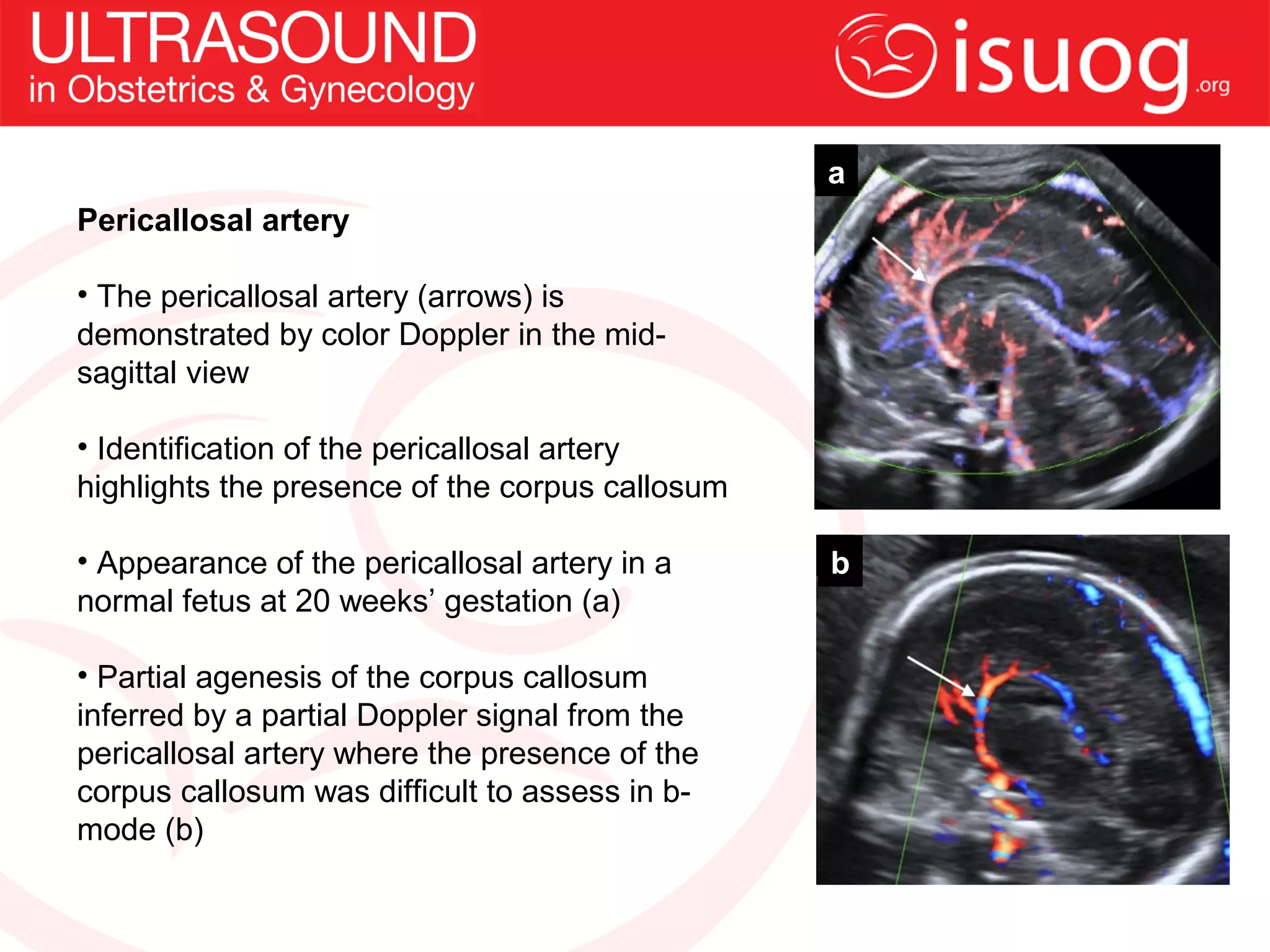 How to image the fetal corpus callosum | PPT