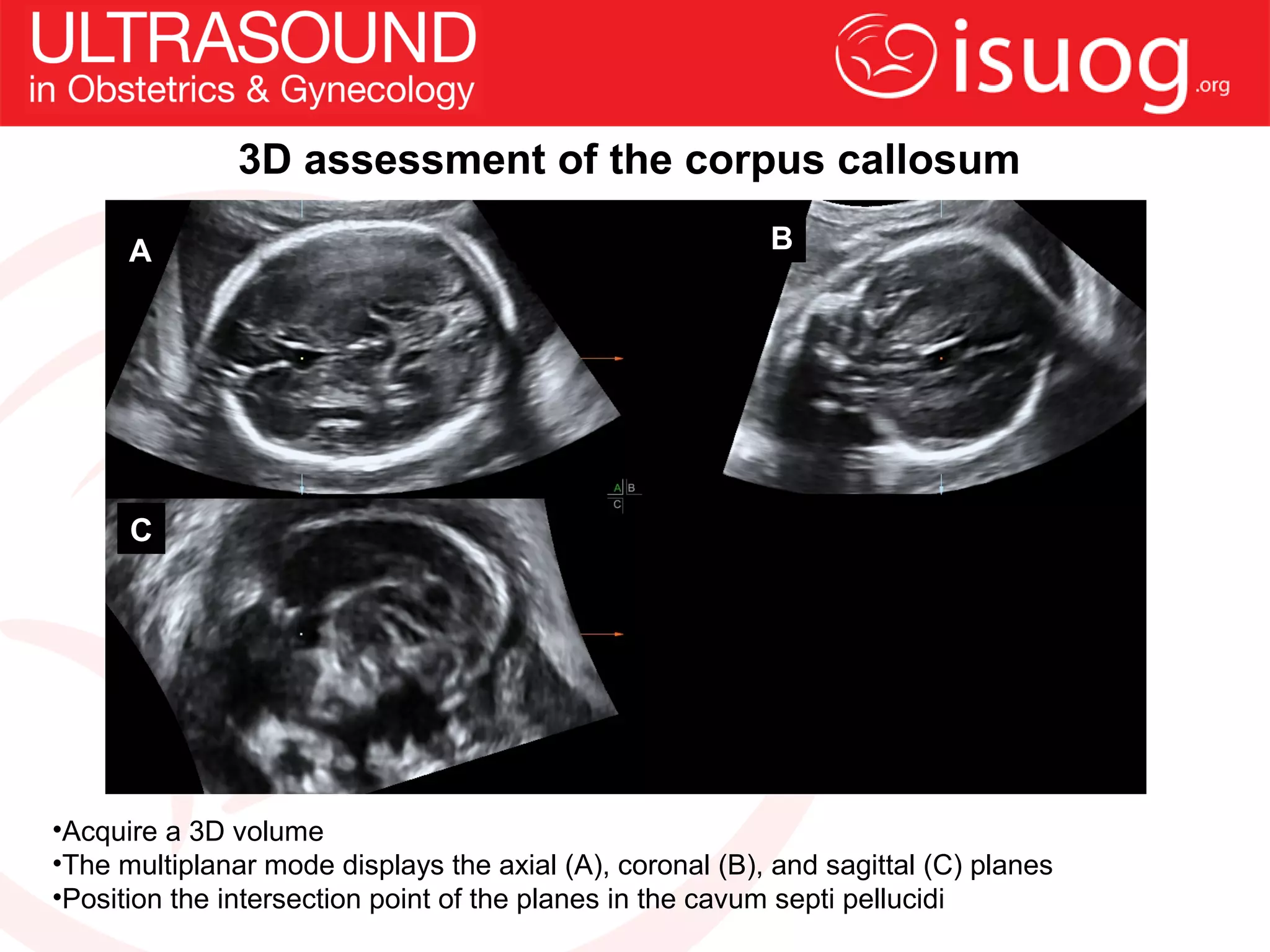 How to image the fetal corpus callosum | PPT