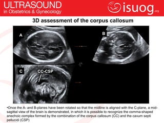 How to image the fetal corpus callosum | PPT