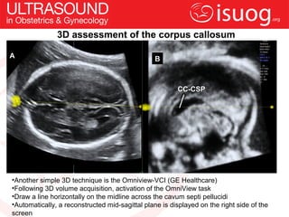 How to image the fetal corpus callosum | PPT