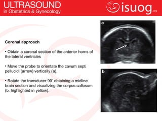 How to image the fetal corpus callosum | PPT