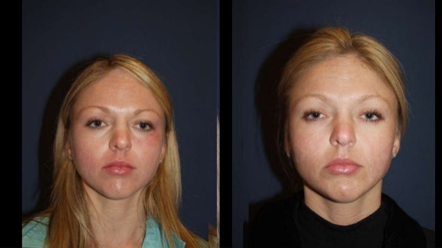 How to improve the midface during