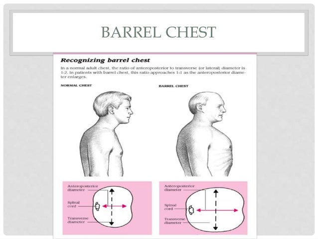Acute exacerbation of COPD