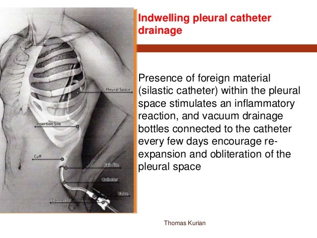 Pleural effusion - How to manage
