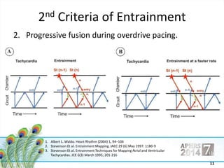 How to perform and interpret entrainment pacing Basics | PPTX