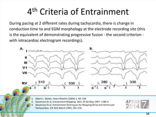 How to perform and interpret entrainment pacing Basics | PPTX