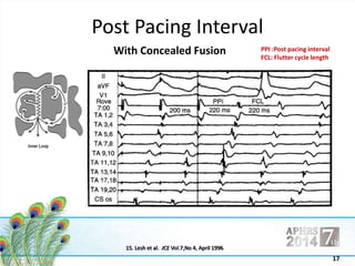 How to perform and interpret entrainment pacing Basics | PPT
