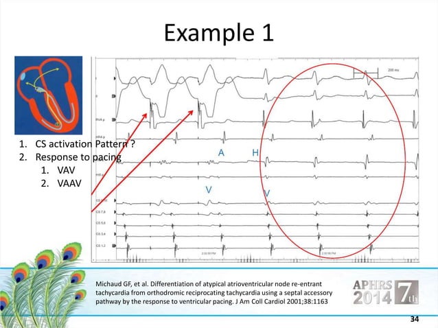 How to perform and interpret entrainment pacing Basics | PPTX