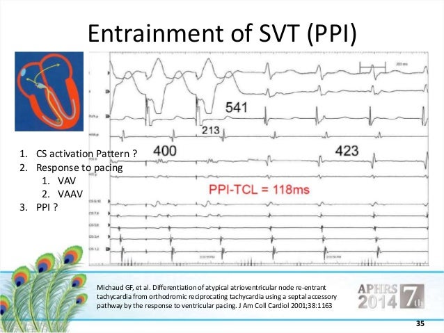 How to perform and interpret entrainment pacing Basics