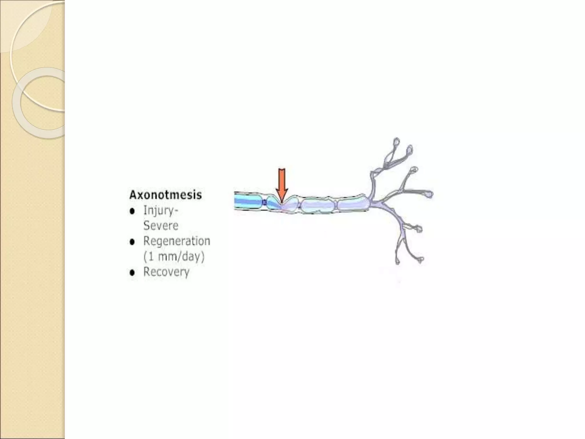 How to Prevent Lingual nerve Damage during Mandibular 1.ppt