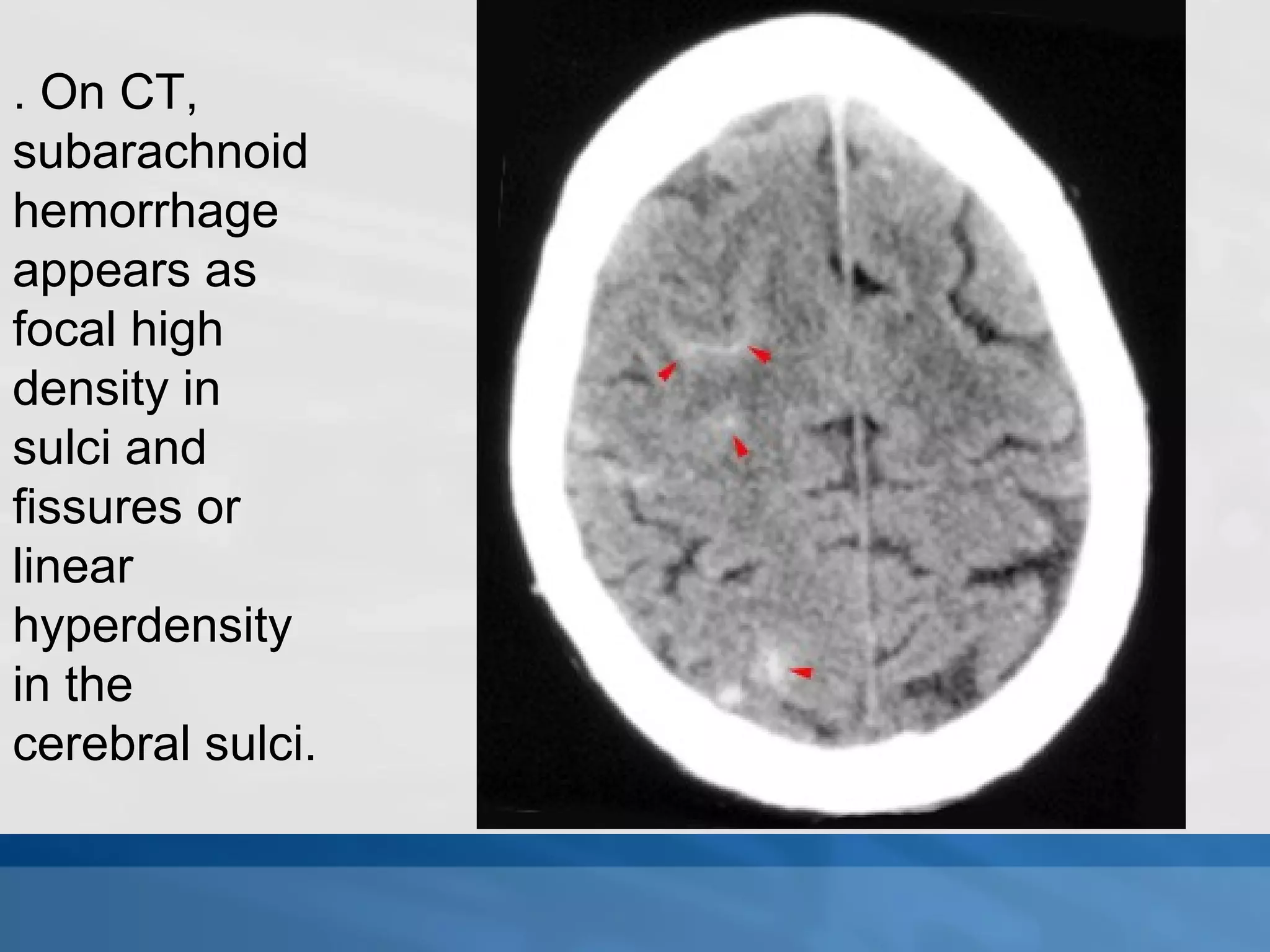 How to read a brain ct scan moderate | PPT